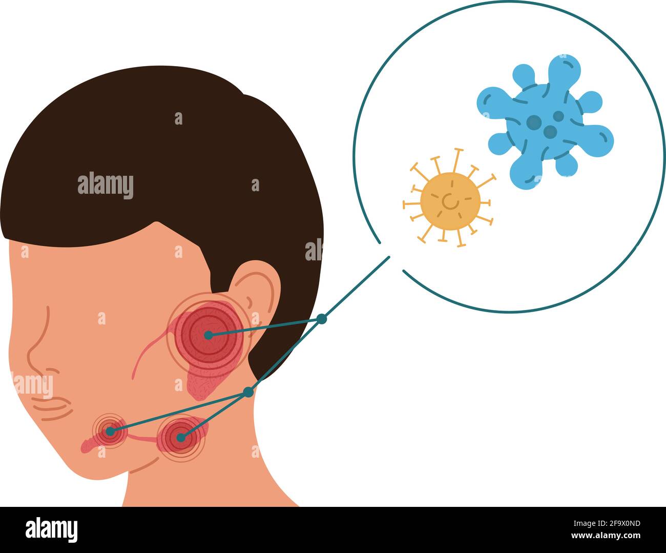 A person with viral inflammation of the salivary glands. Vector ...