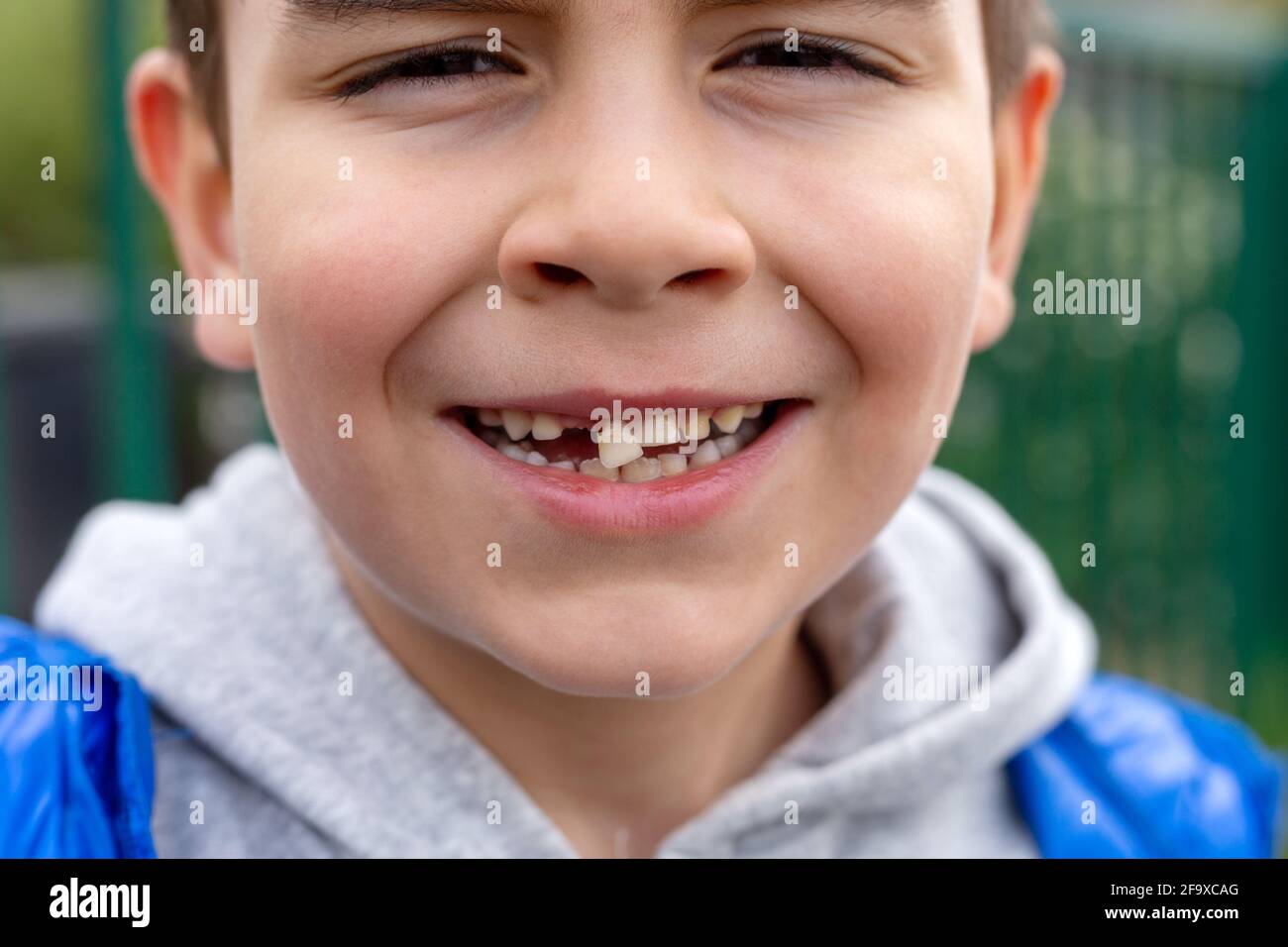 The baby boy smiling with wobbly milk tooth in open mouth. First molar ...