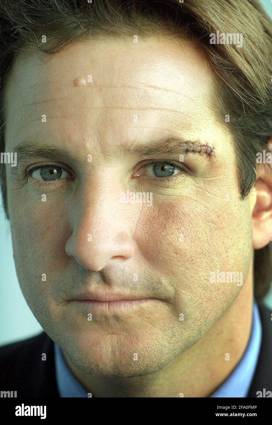 MARK NICHOLAS WITH SCAR AFTER BEING MUGGED Stock Photo - Alamy