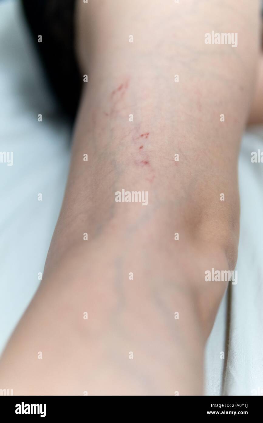 Tortuous vein hi-res stock photography and images - Alamy