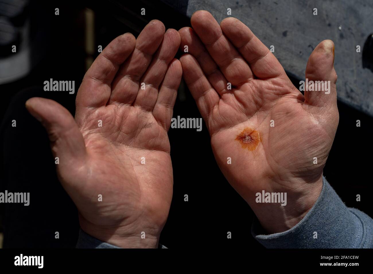 male hands, working Sick hands of a man. Calluses on the palms. Cropped ...