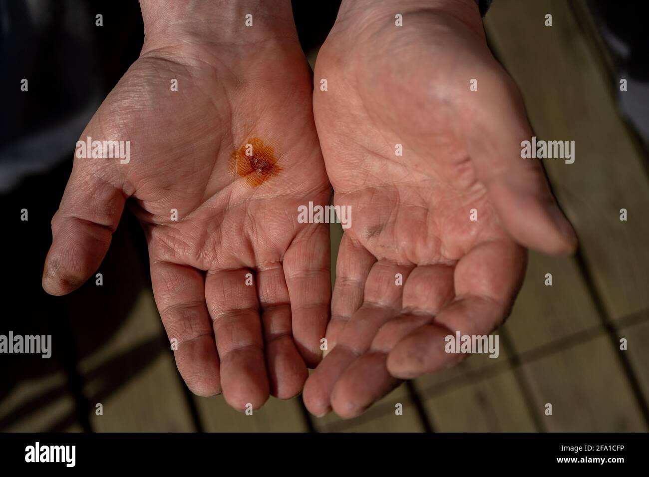 male hands, working Sick hands of a man. Calluses on the palms. Cropped ...