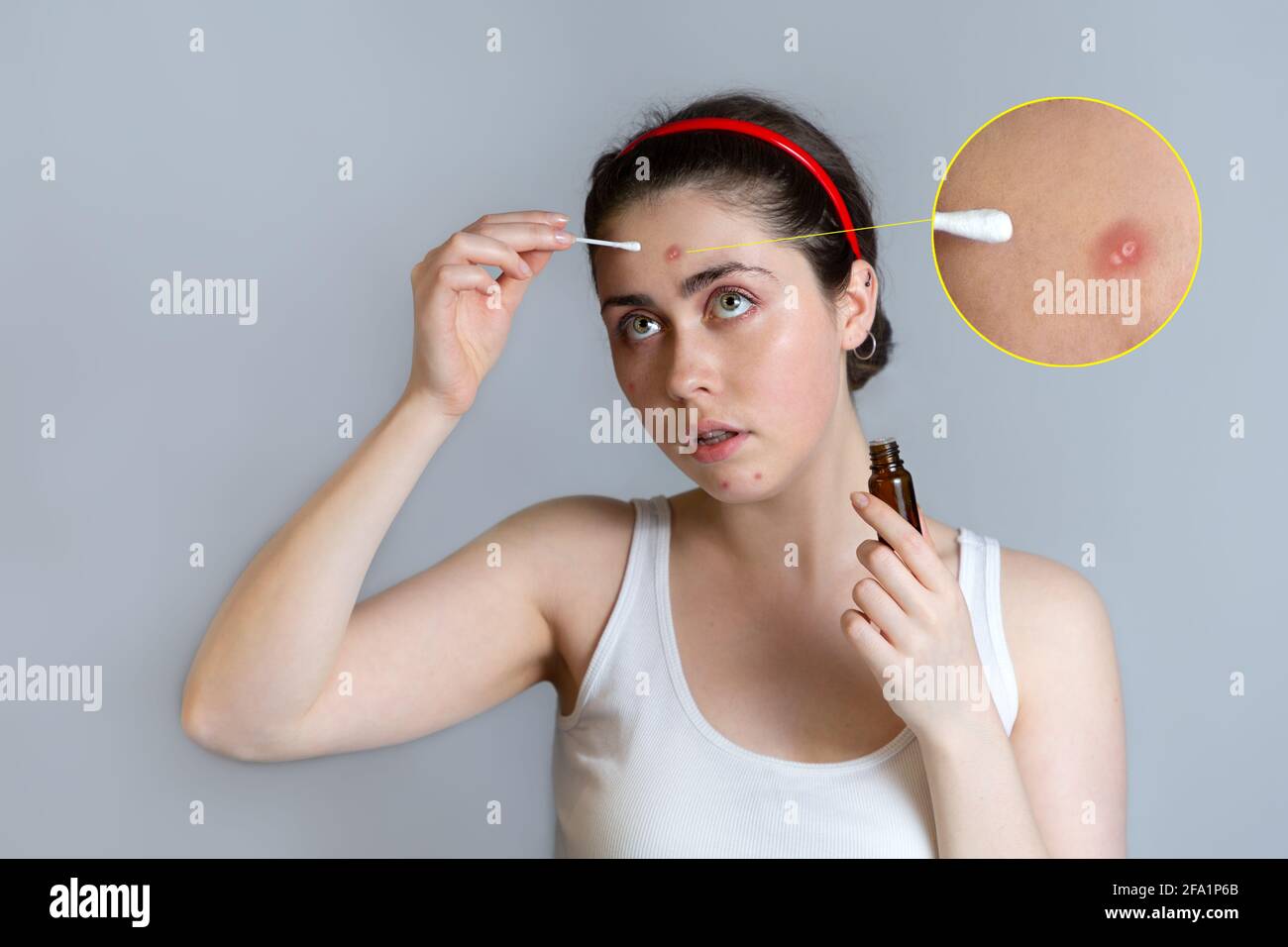 A beautiful young woman with acne on the face, apply on the pimples ...