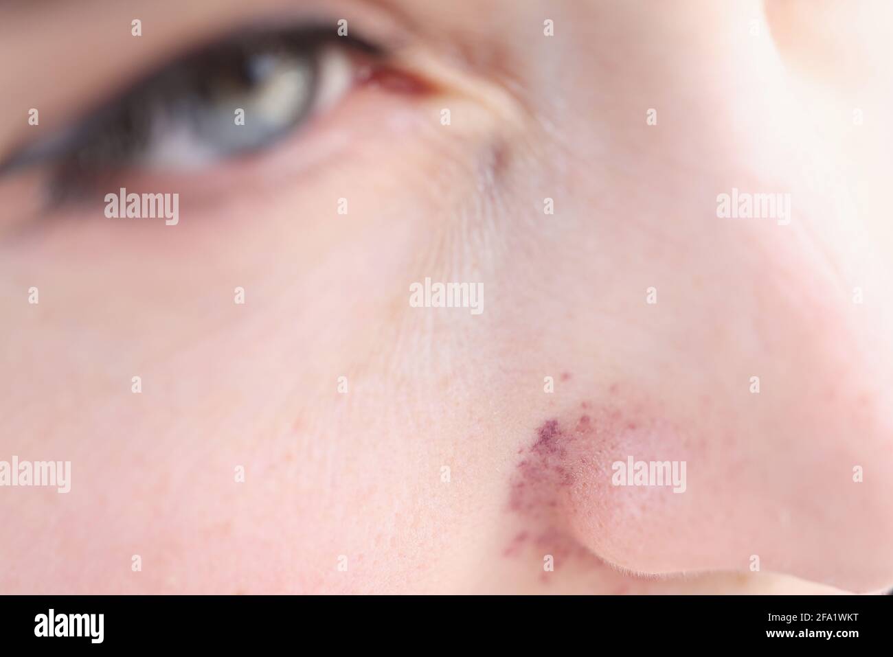 Red cyanotic rash on woman nose closeup Stock Photo - Alamy