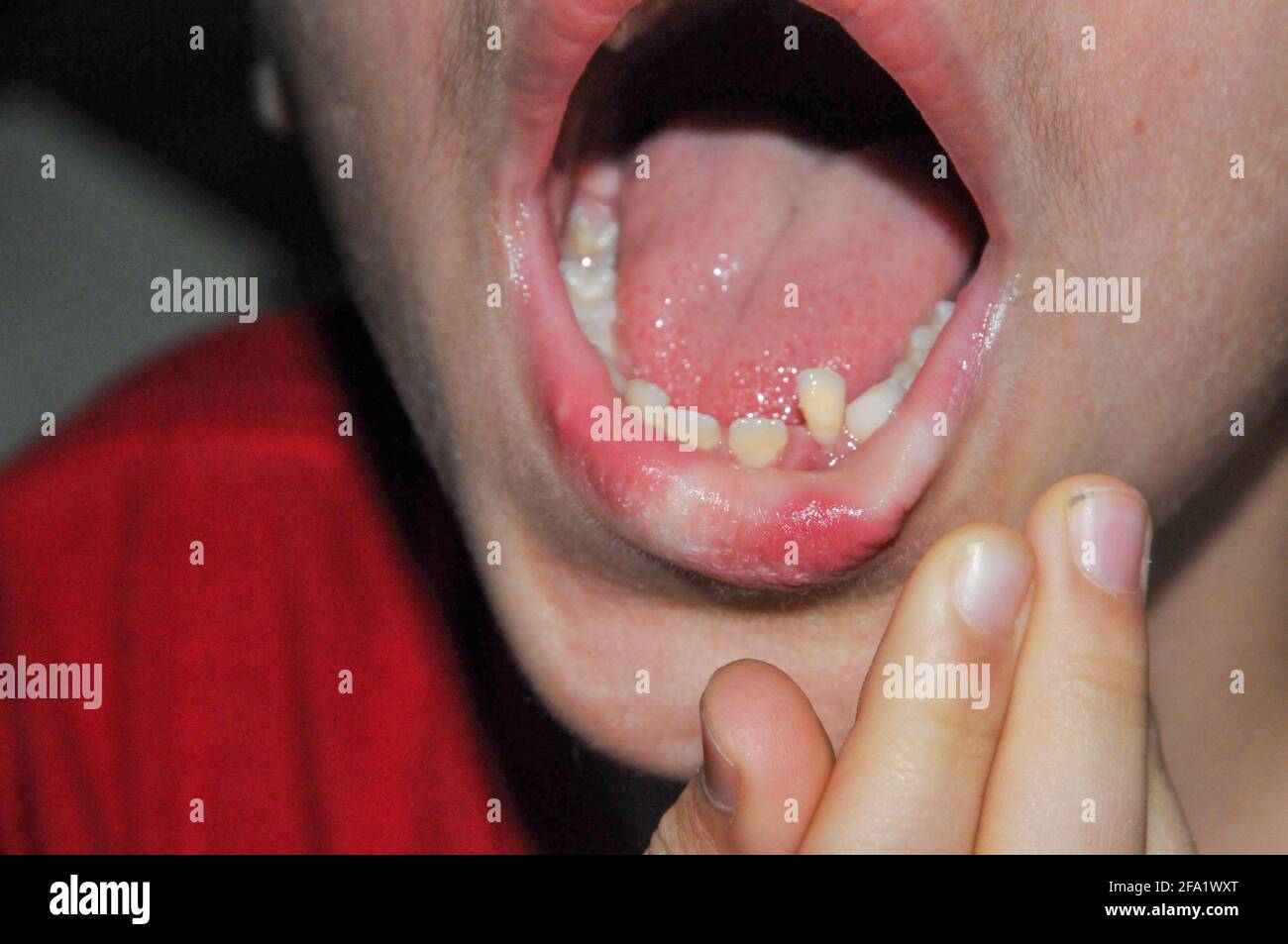 Two front teeth missing hi-res stock photography and images - Alamy