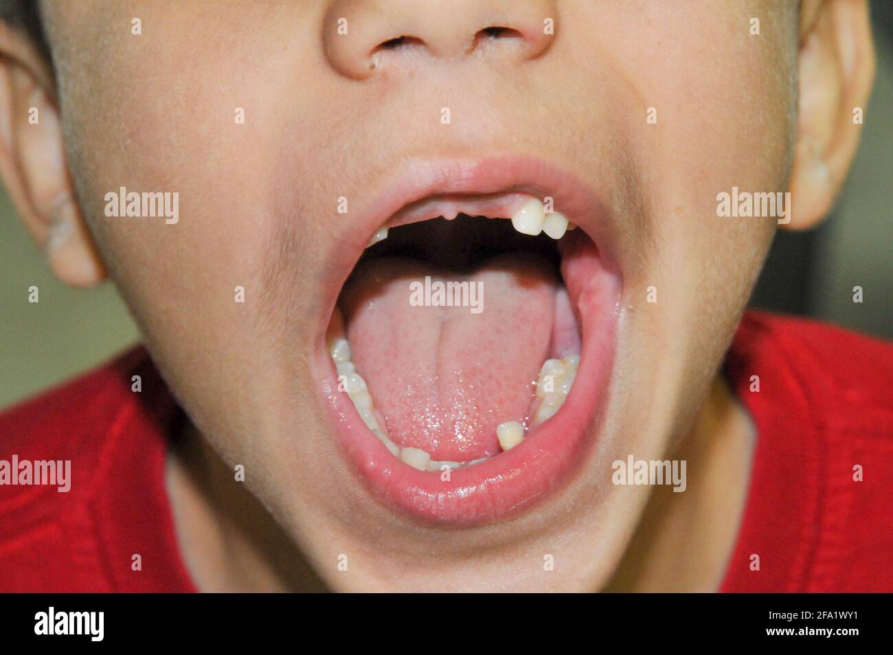 Young boy of six with a loose bottom tooth and missing two front teeth ...