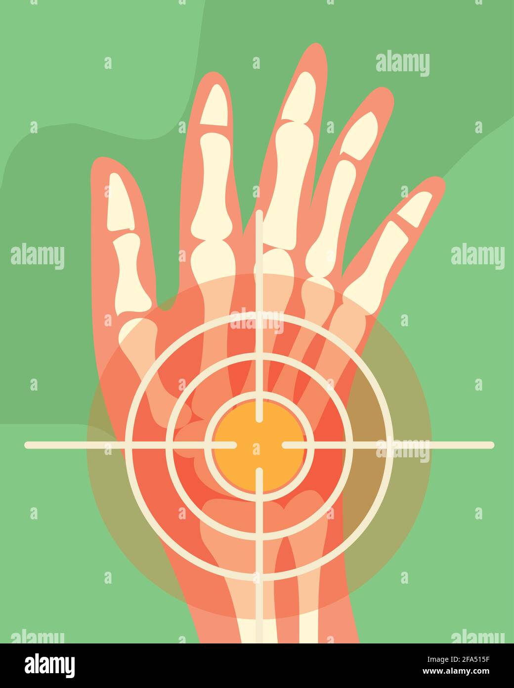 Ray hand arthritis Stock Vector Images - Alamy