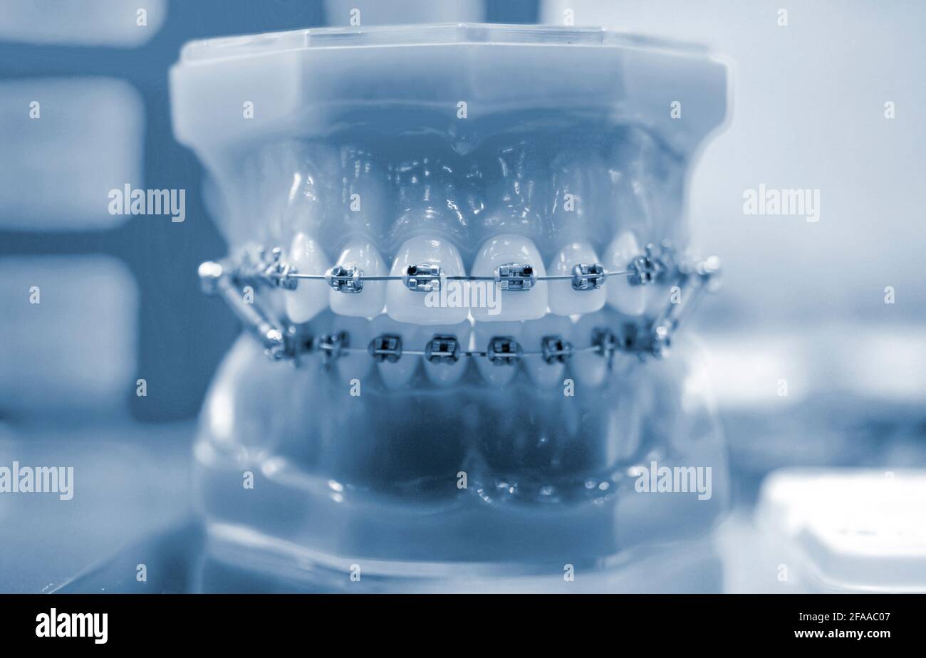 Braces on artificial teeth jaws close-up, dental tooth dentistry Stock ...
