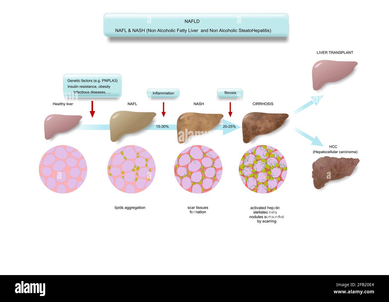 Steatosis hepatitis hi-res stock photography and images - Alamy