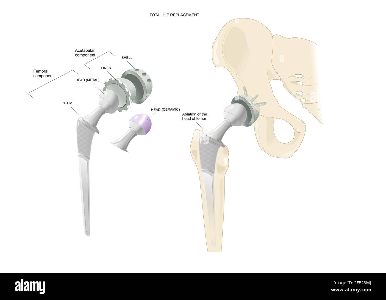 Total hip replacement hi-res stock photography and images - Alamy