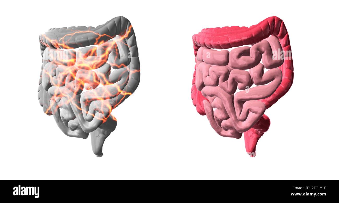 Healthy and unhealthy intestines, conceptual illustration Stock Photo ...