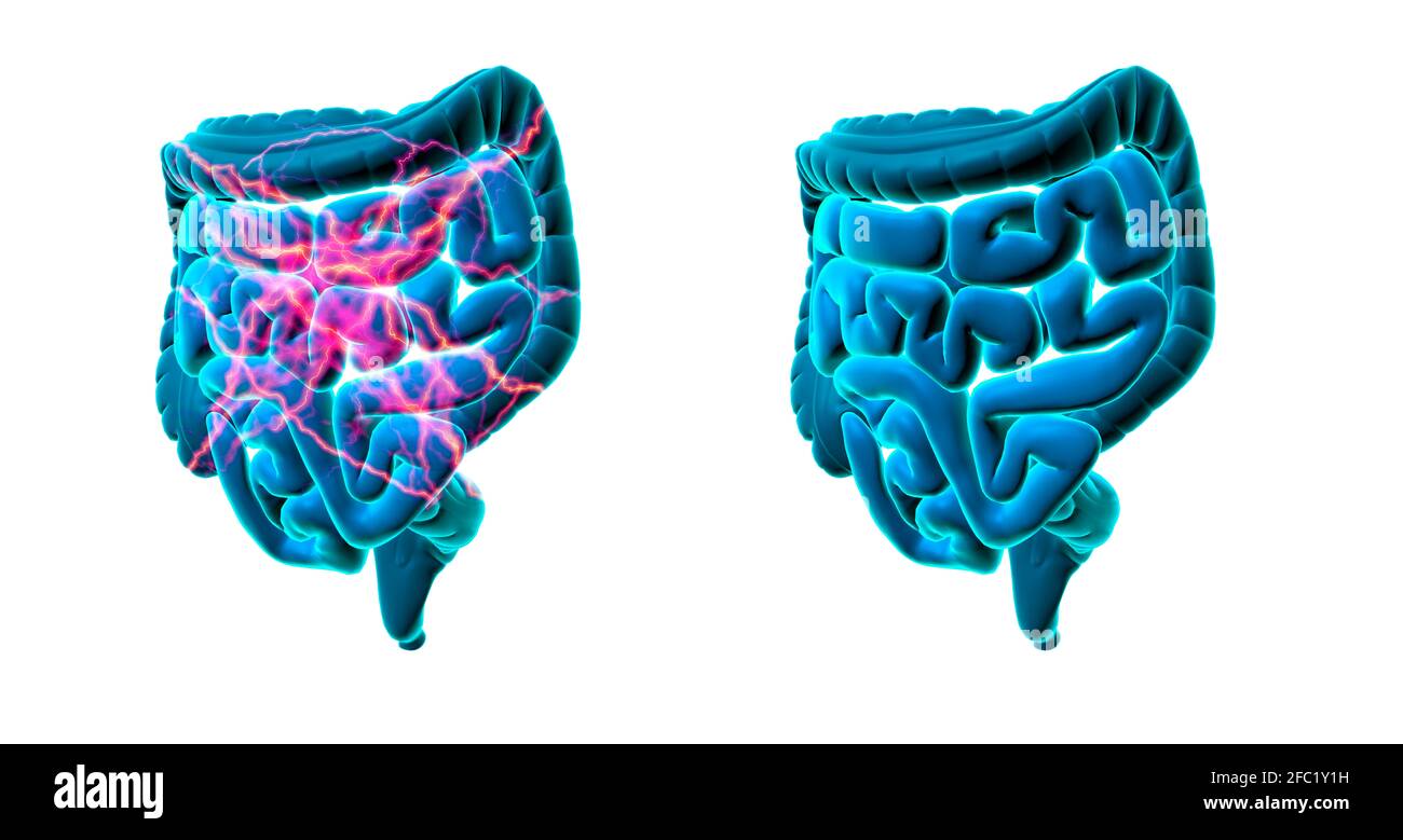 Healthy and unhealthy intestines, conceptual illustration Stock Photo ...
