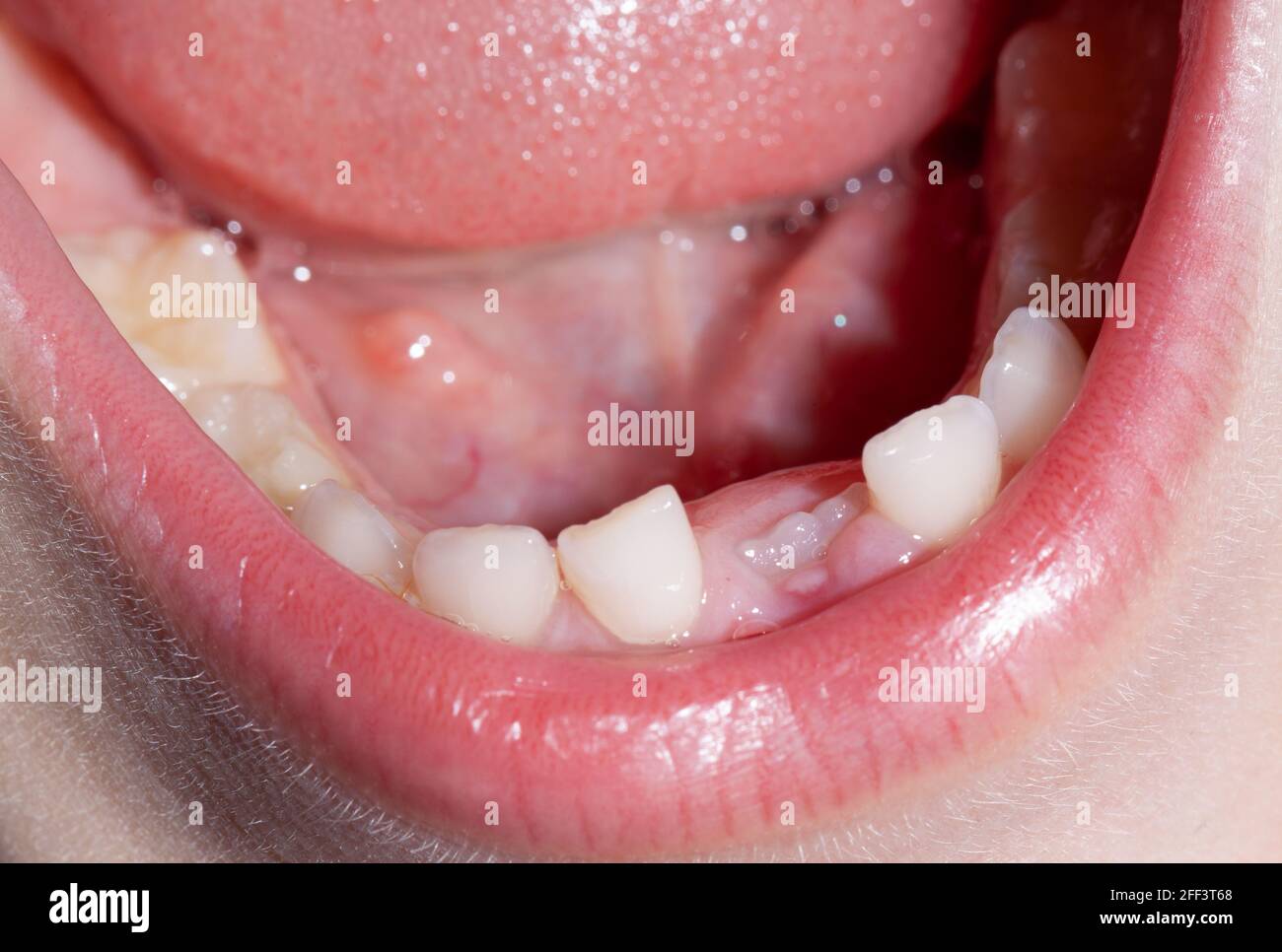 The child's first baby tooth fell out. Photo in macro scale Stock Photo ...
