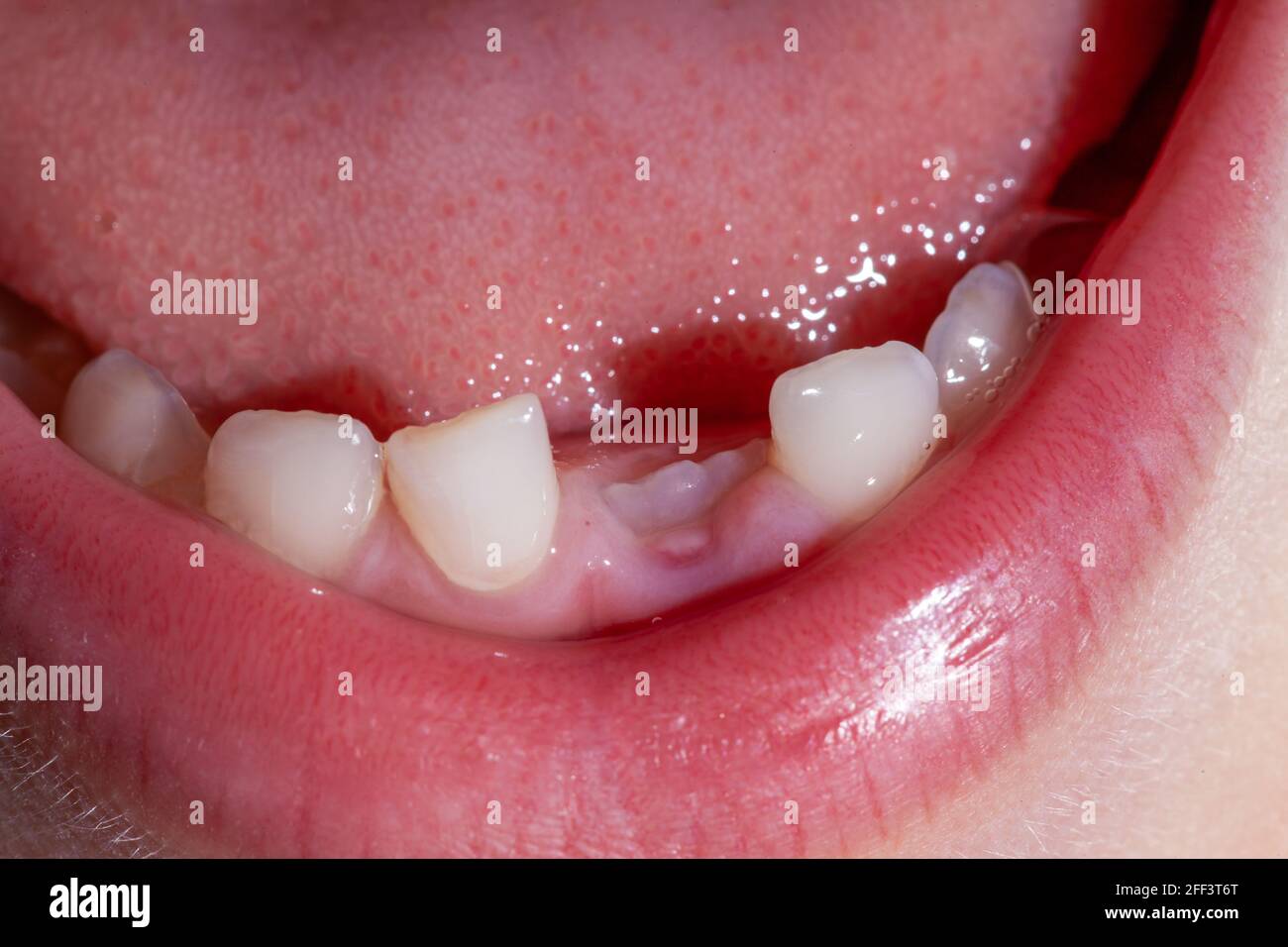 First molar hi-res stock photography and images - Alamy