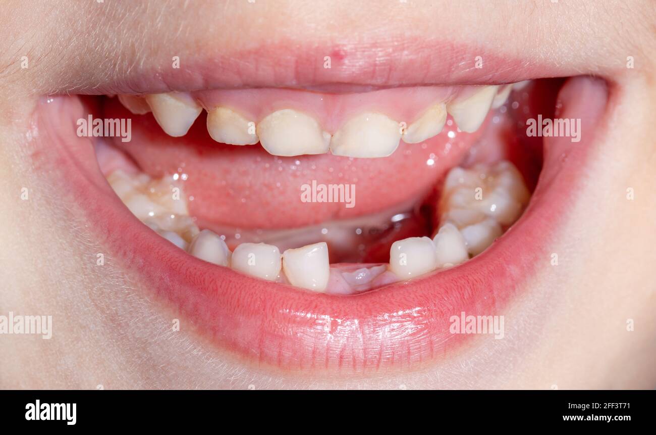 First molar hi-res stock photography and images - Alamy