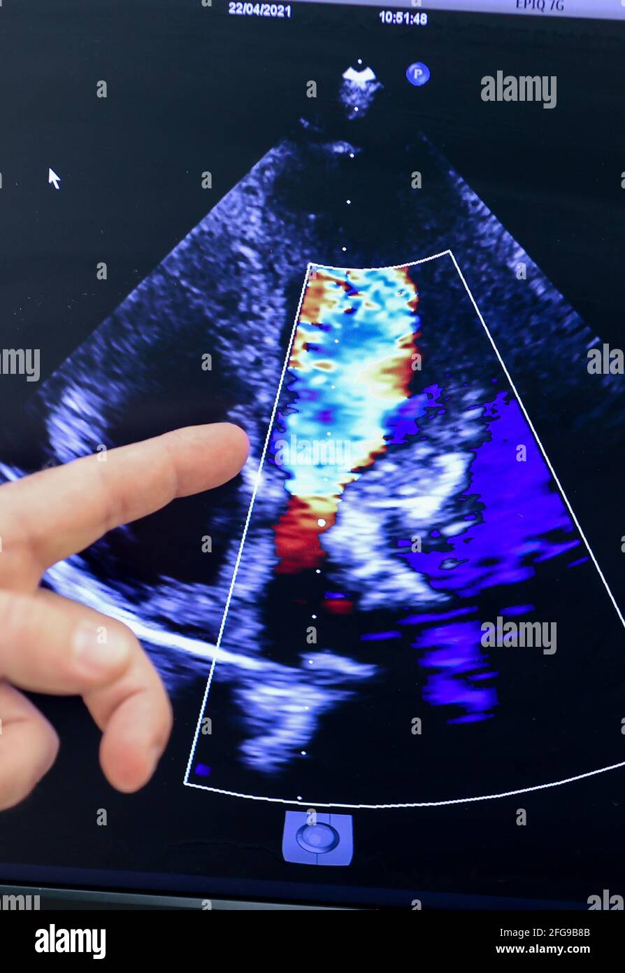 Heart surgery scar hi-res stock photography and images - Alamy