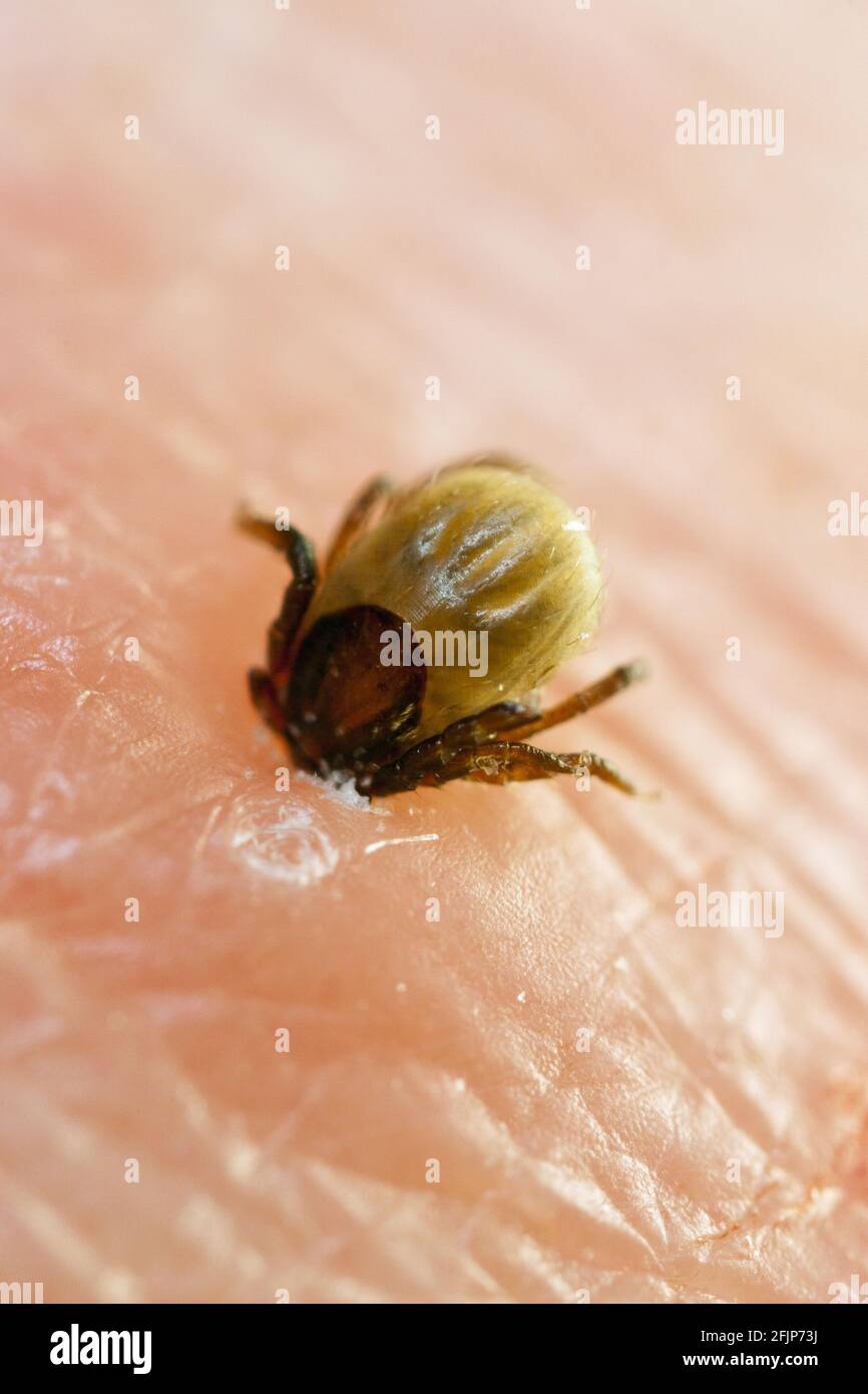 Tick bitten into human skin, common Castor Bean Tick (Ixodes ricinus ...