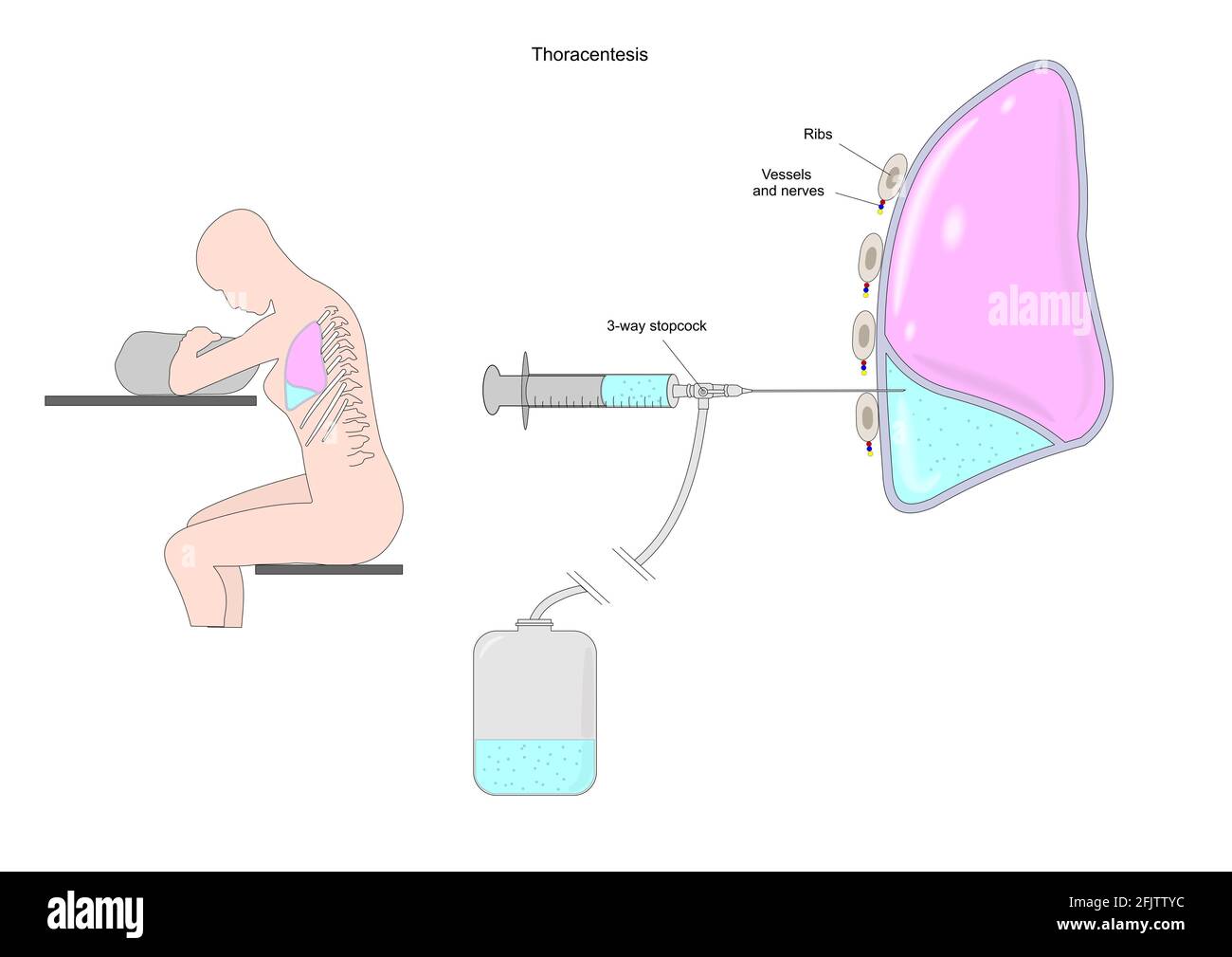 Pleural space hi-res stock photography and images - Alamy