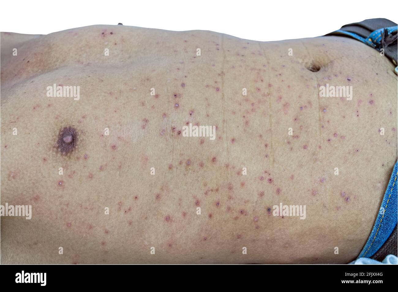Close up A man and papule rash in body on white background.Saved with ...