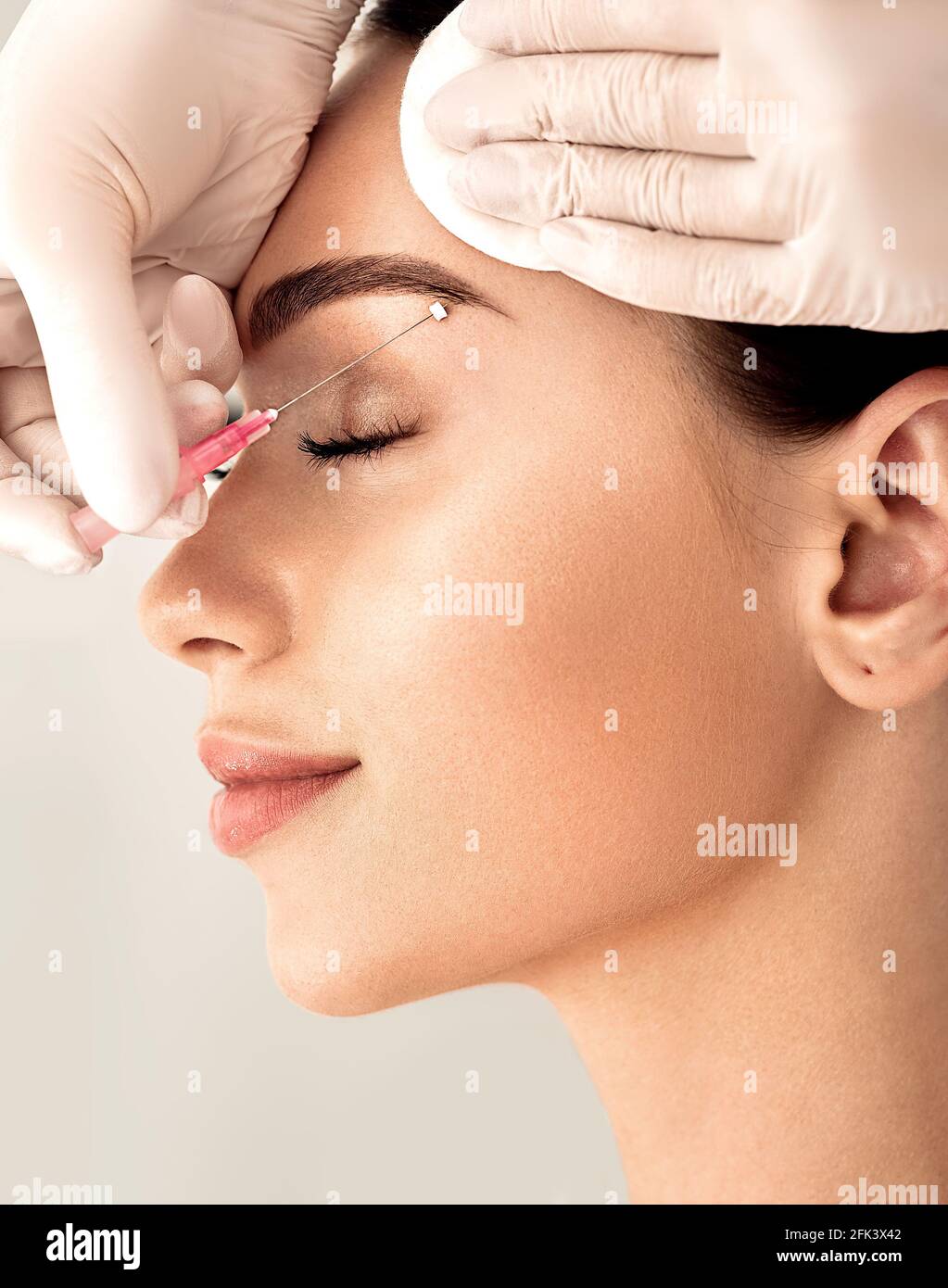 Lifting eyebrow lines using mesothreads. Needle with mesothreads near a ...