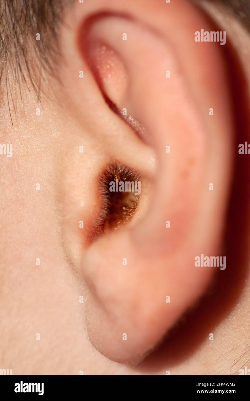 Photo of an ear full of earwax. Close-up ear. Personal hygiene Stock ...