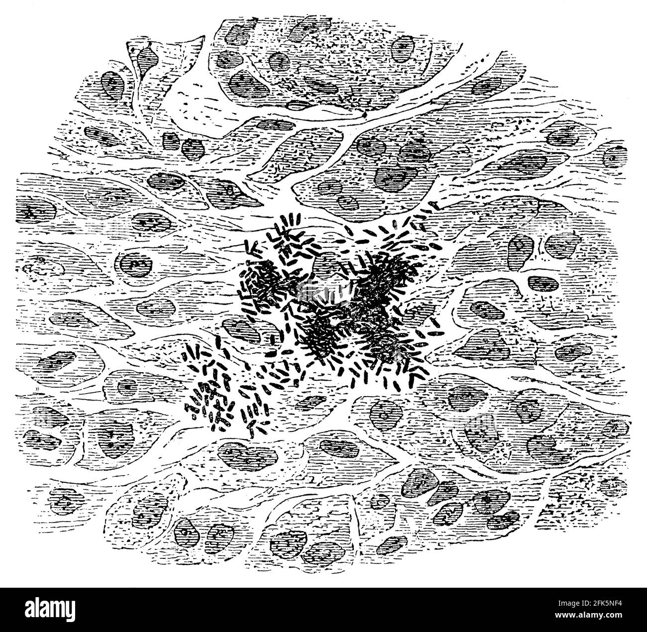 Typhoid fever scan hi-res stock photography and images - Alamy