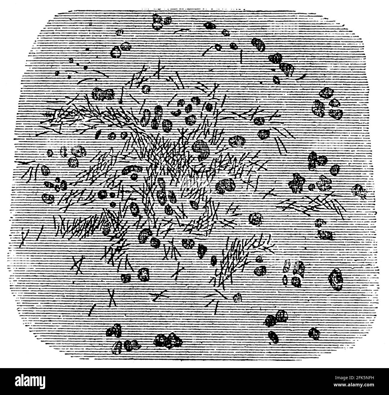 Tubercle bacilli Black and White Stock Photos & Images - Alamy