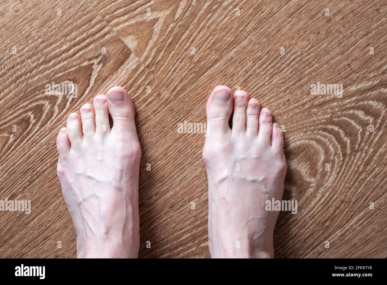 Tired barefoot female legs with protruding veins on a wooden background ...