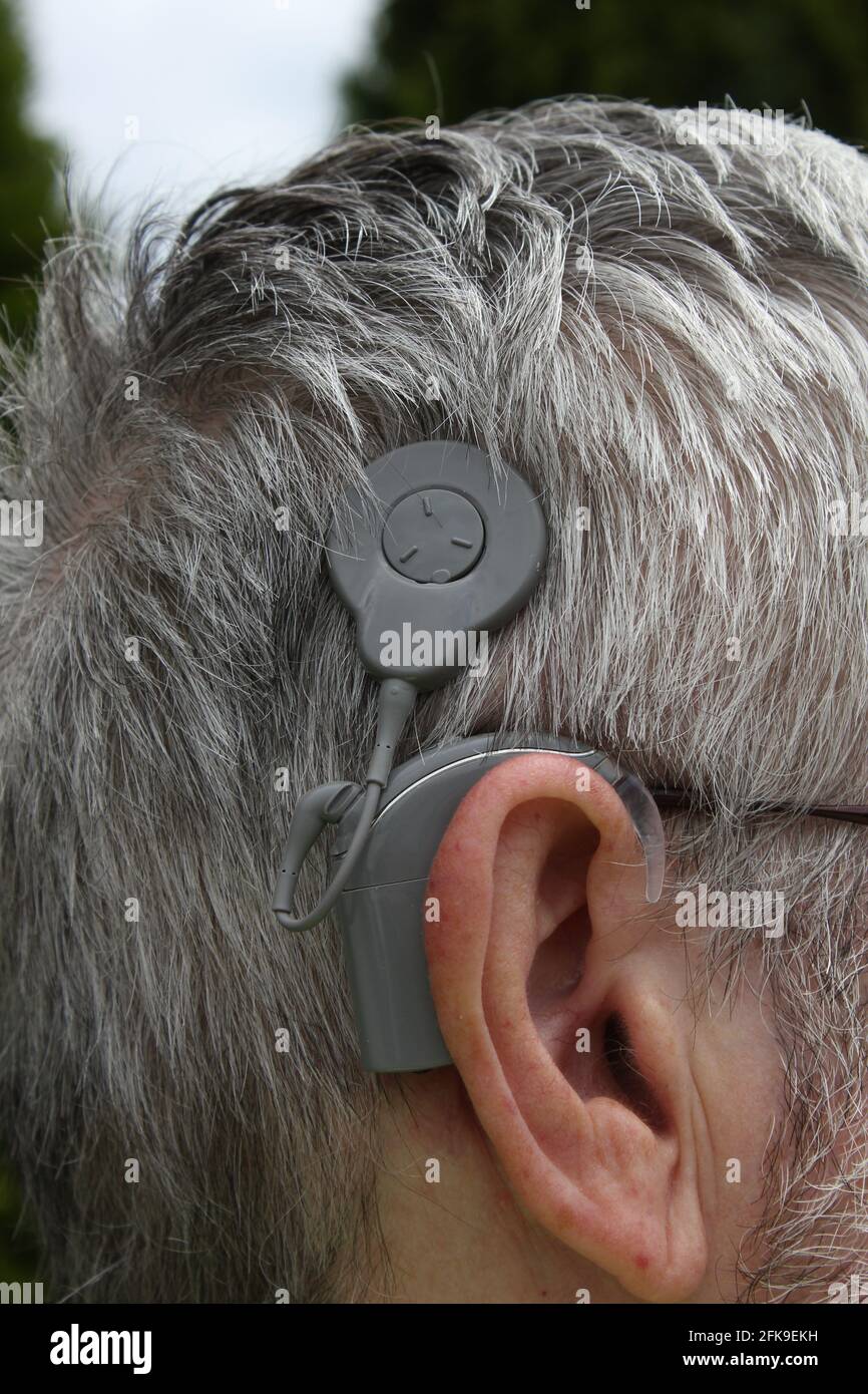 Cochlear Implants High Resolution Stock Photography and Images - Alamy
