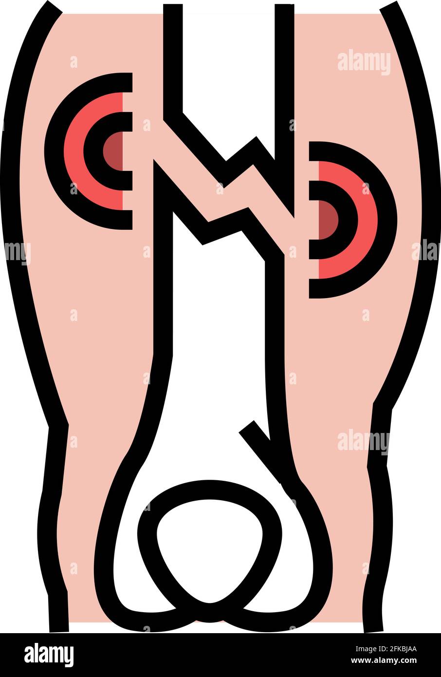 Umbilical Hernia Stock Vector Images Alamy