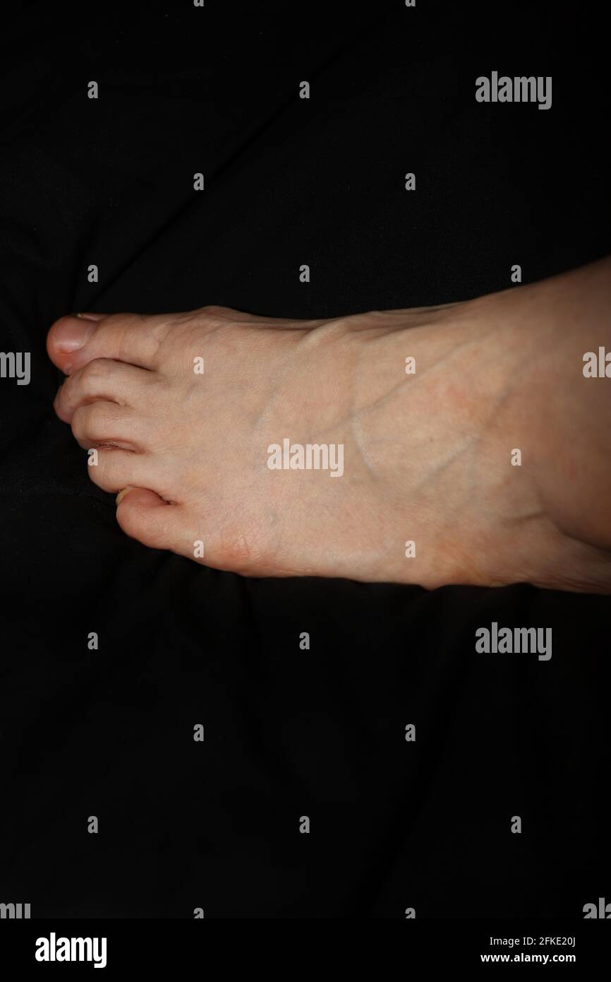 Foot with large veins and crooked pinky toe Stock Photo - Alamy
