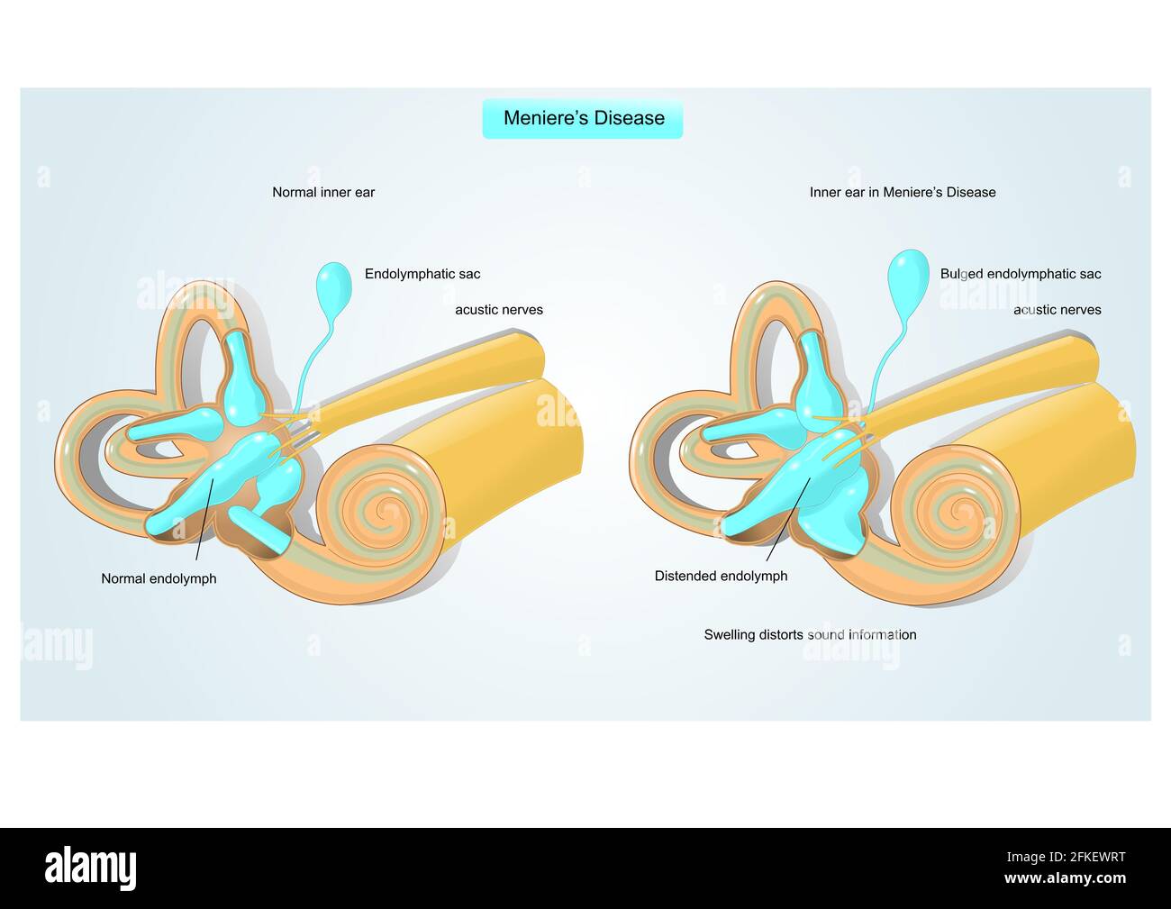 Ear Pathology High Resolution Stock Photography and Images - Alamy