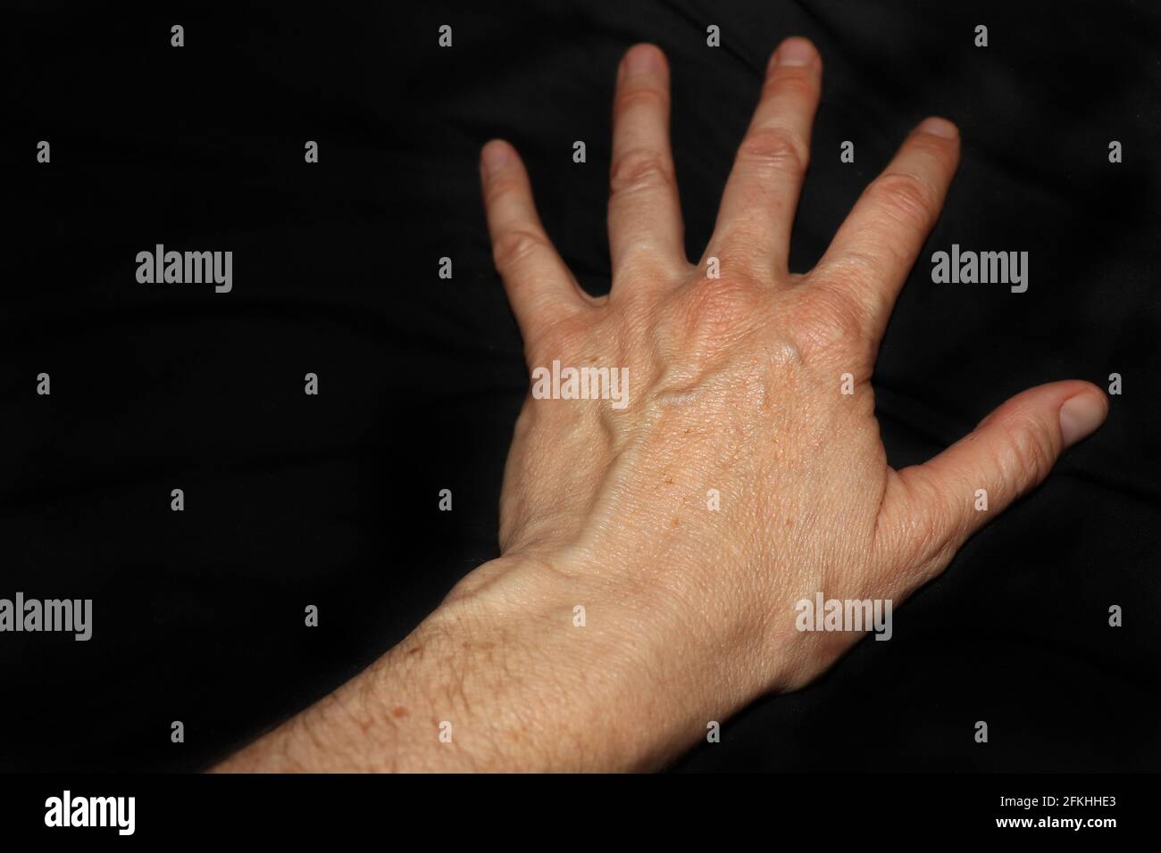 Swollen fingers hi-res stock photography and images - Alamy