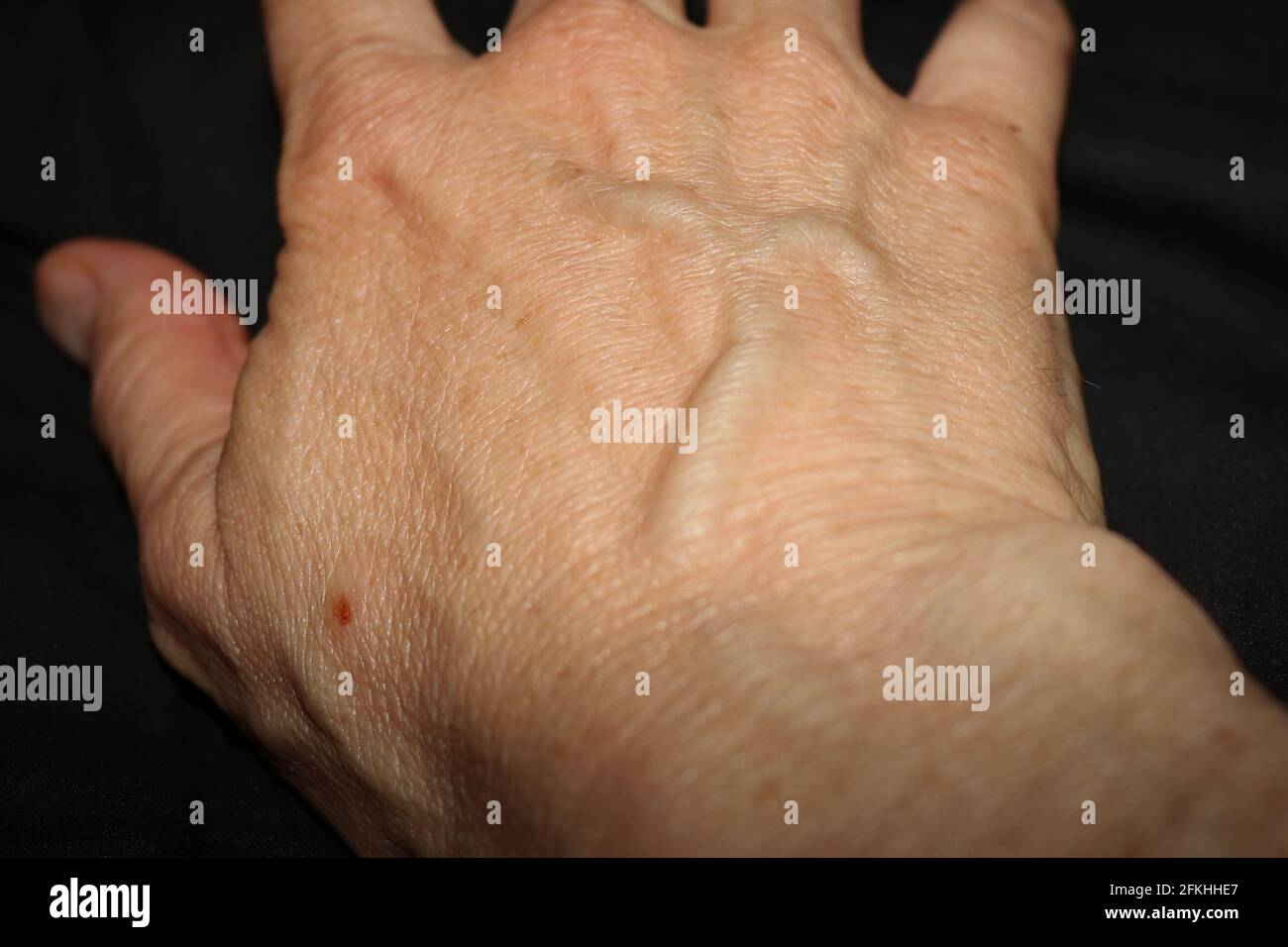 Enlarged veins on the back of a woman's right hand Stock Photo - Alamy