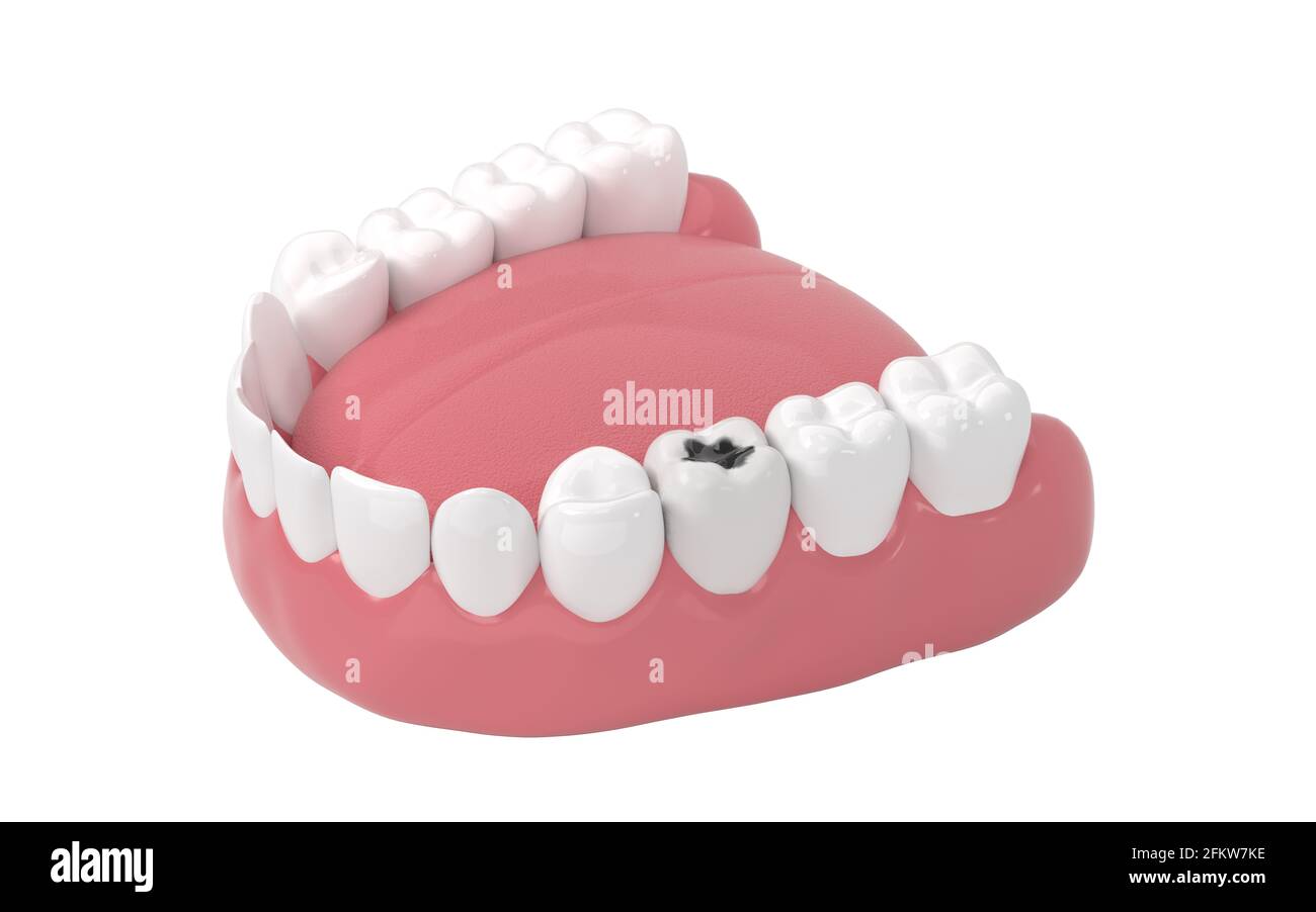 Tooth decay, unhealthy teeth, 3d rendering. Computer digital drawing ...