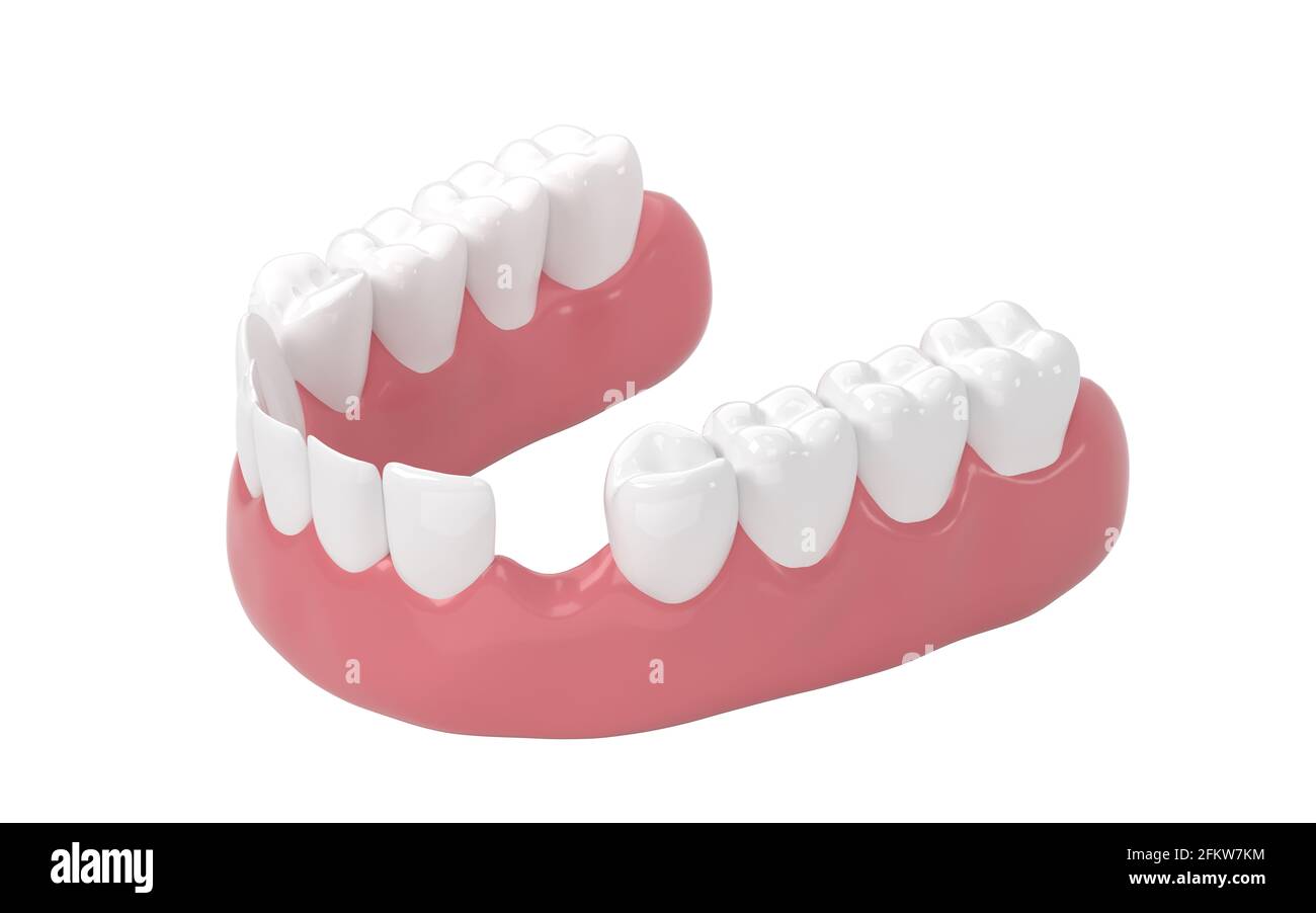 Lack of tooth, teeth treatment, 3d rendering. Computer digital drawing ...