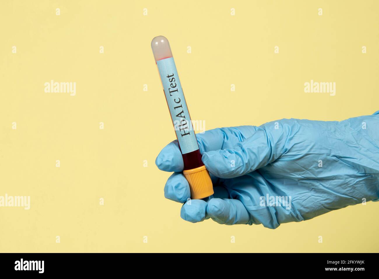 Blood sample in a vacuum tube for hemoglobin HbA1c test diabetes ...