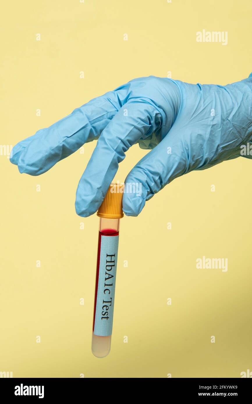 Blood sample in a vacuum tube for hemoglobin HbA1c test diabetes ...