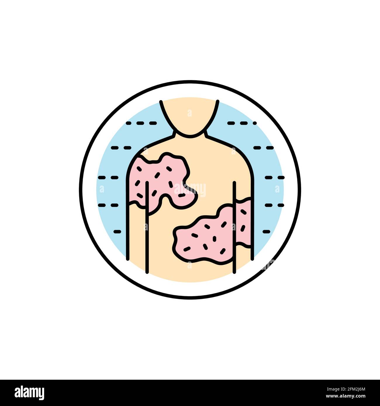 Urticaria vector vectors hi-res stock photography and images - Alamy