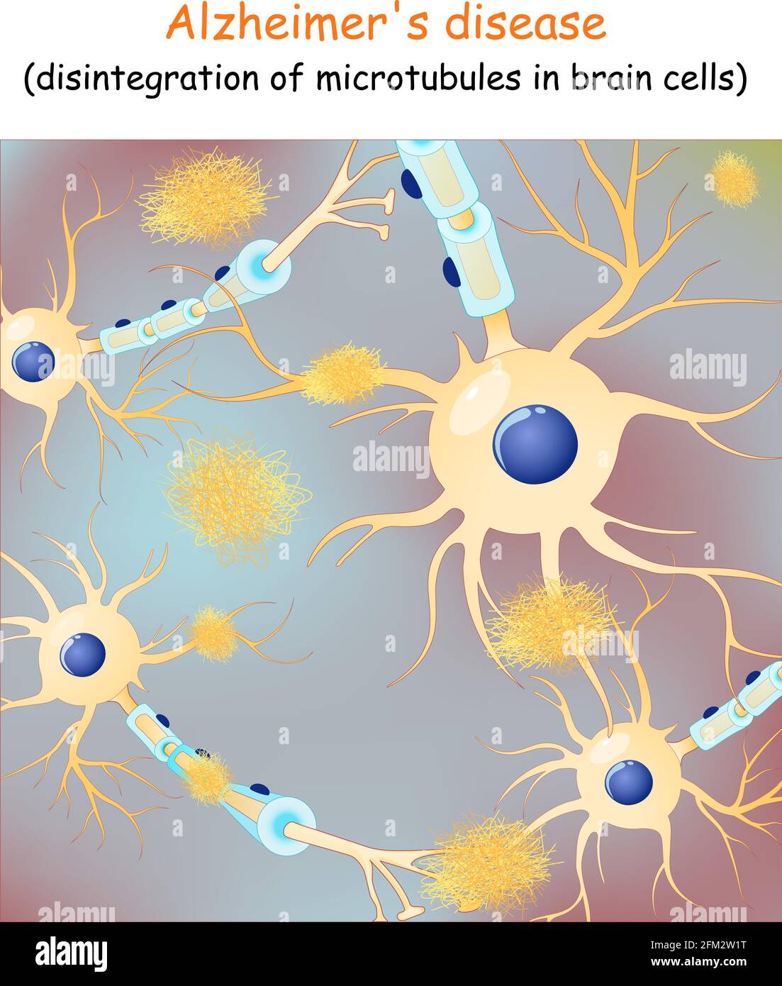 Brain Atrophy Alzheimers Stock Vector Images Alamy