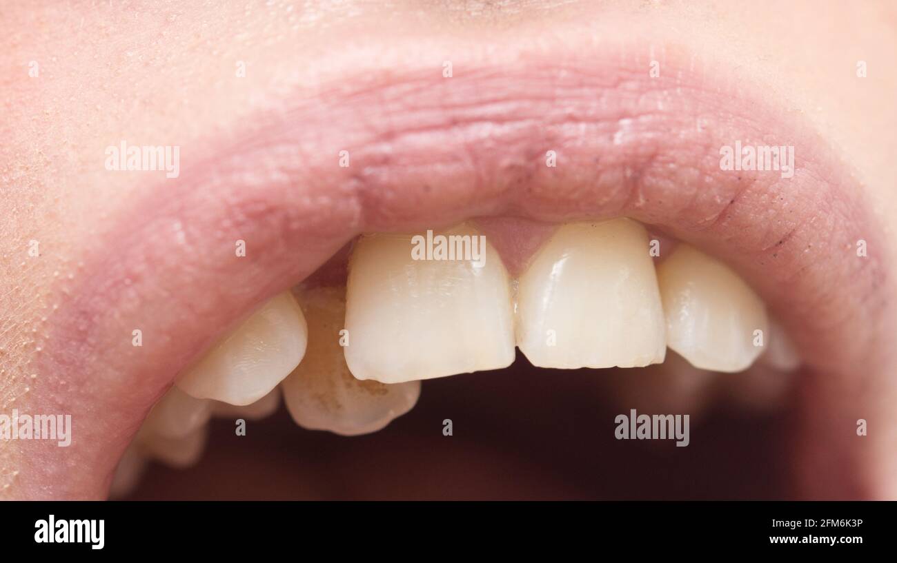 Adult man crooked teeth hi-res stock photography and images - Alamy