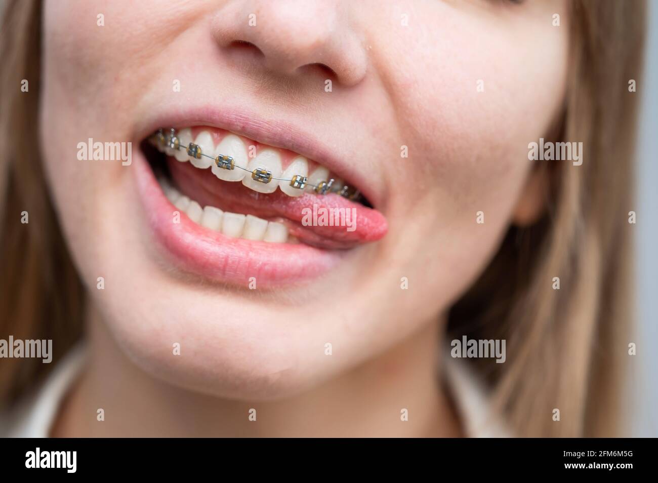 Teeth correction hi-res stock photography and images - Alamy