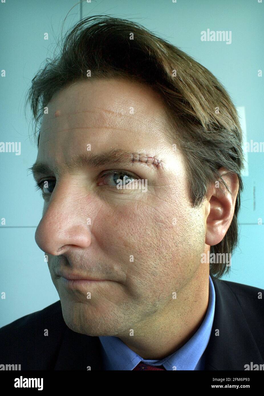 MARK NICHOLAS WITH SCAR AFTER BEING MUGGED LAST NIGHT Stock Photo - Alamy