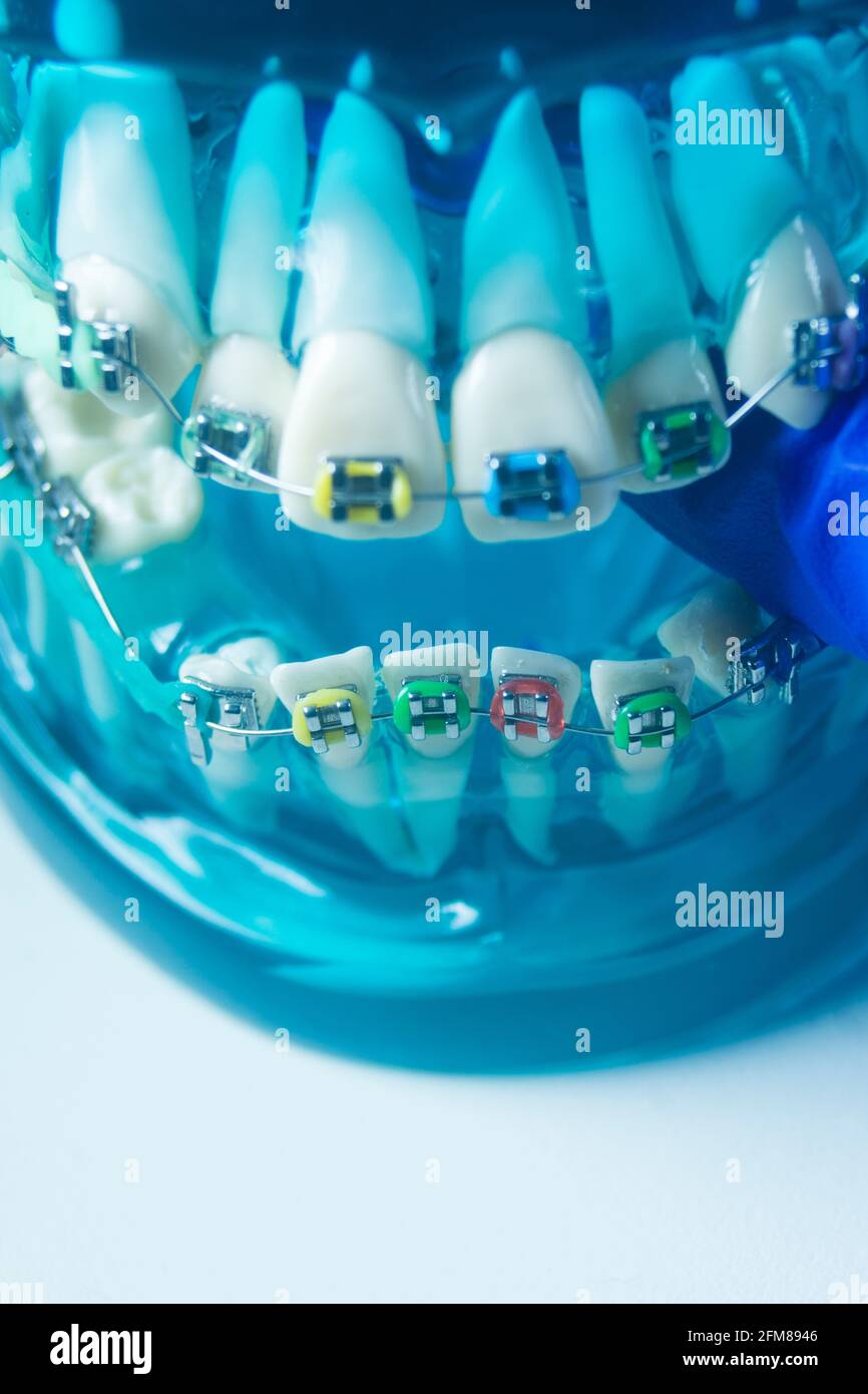 Modern metal brackets aligner straighterners used to correct alignment ...