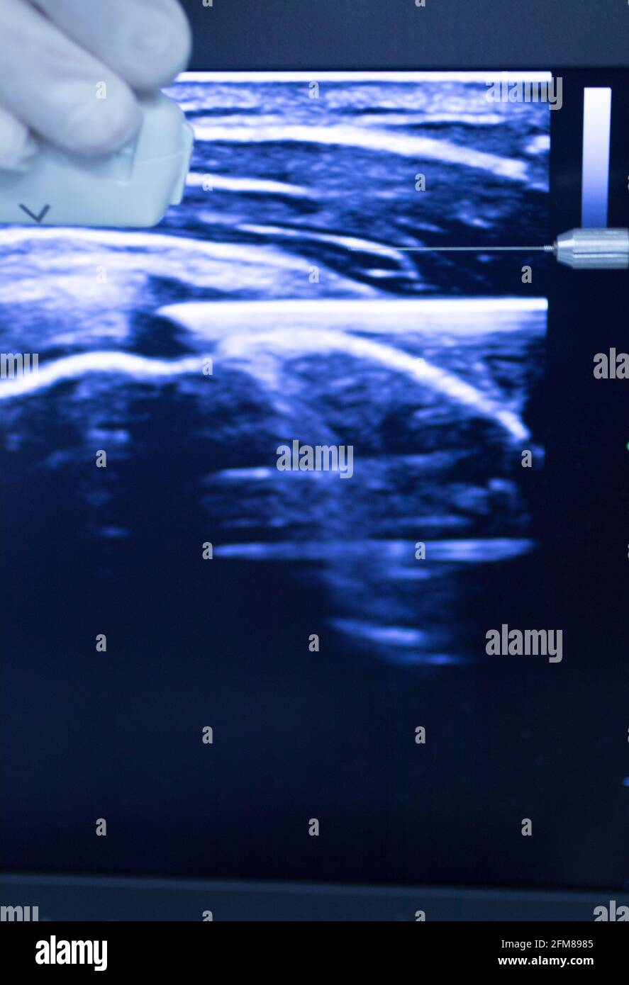 EPI Intratissue Percutaneous Electrolysis dry needling ultrasound ecography scan physiotherapy ...