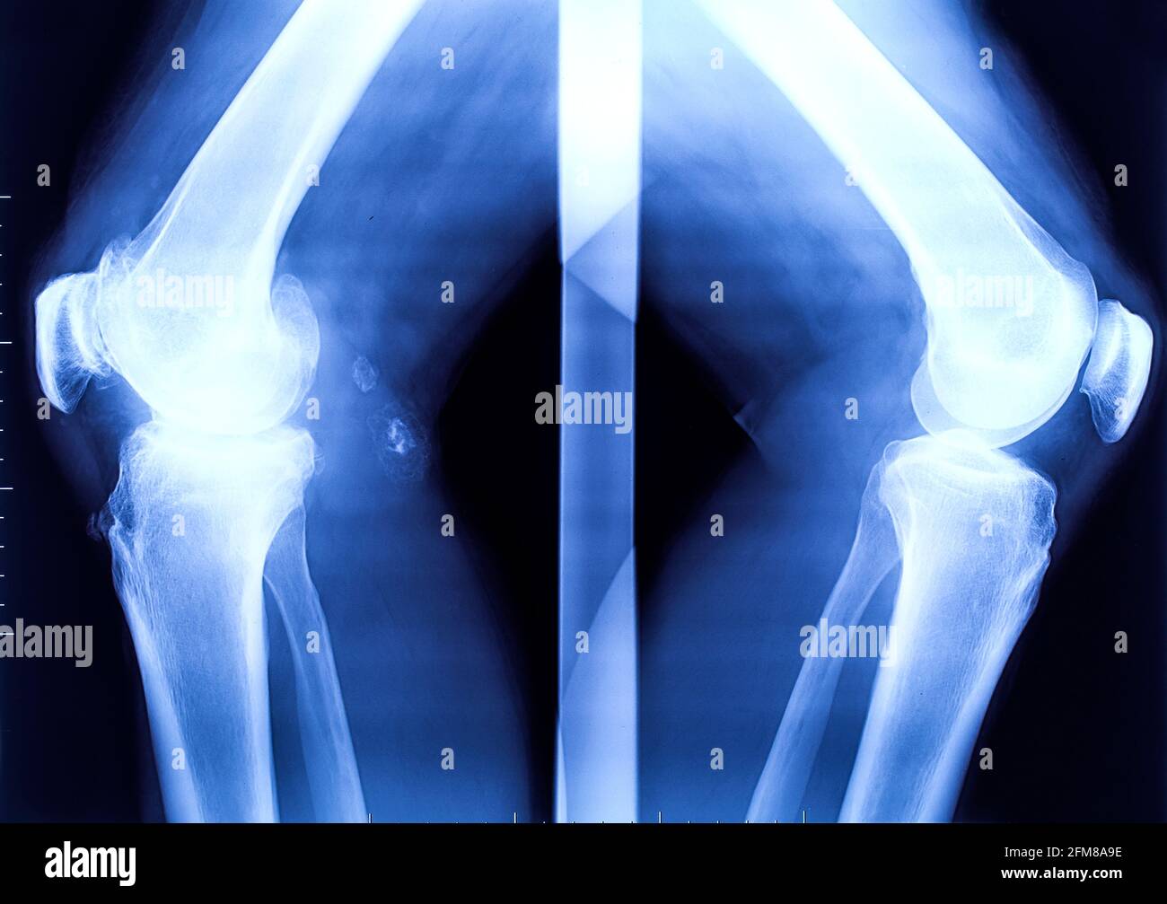 X-ray of the two bended knees: healthy and sick Stock Photo - Alamy
