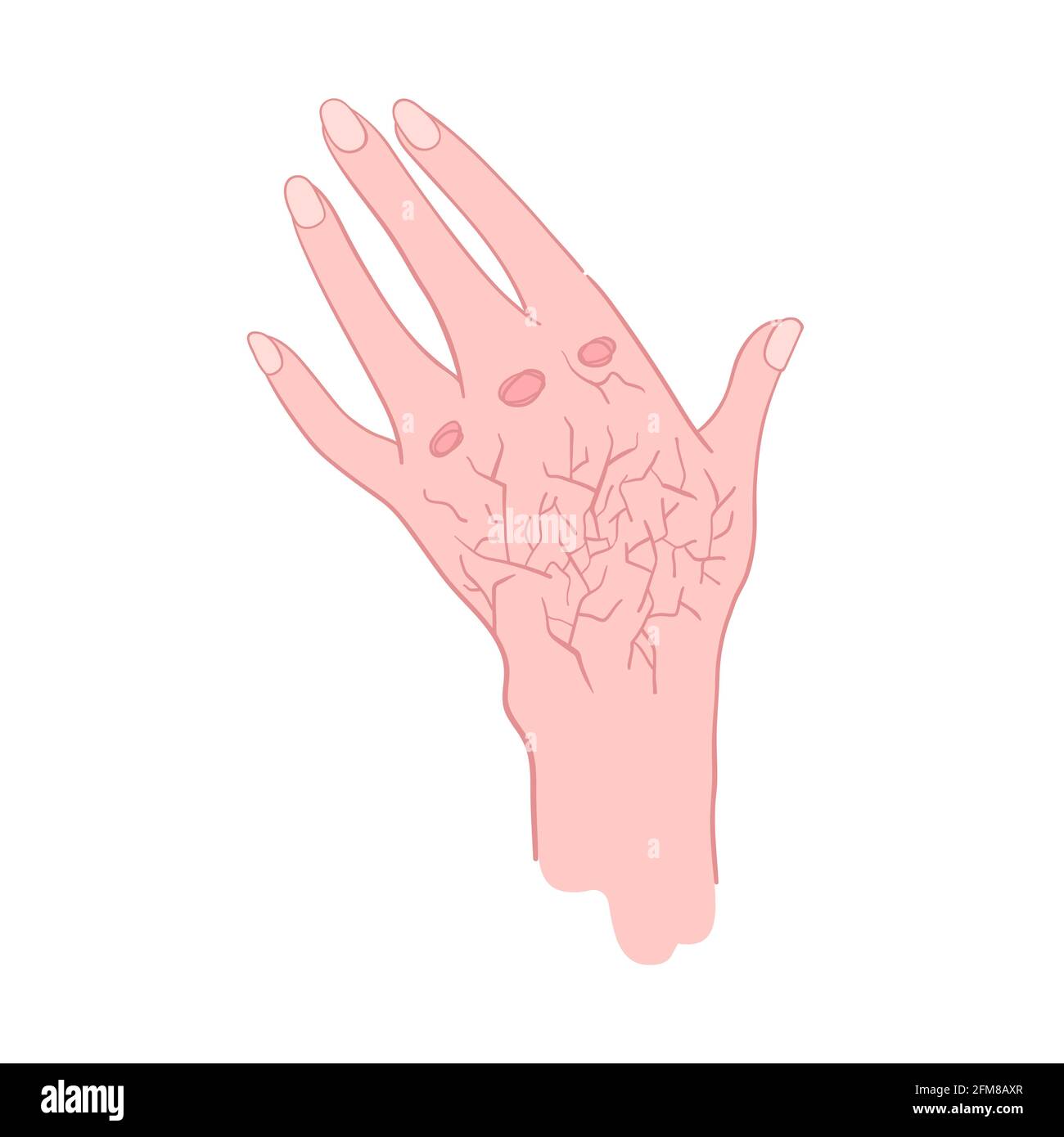 Woman hand with dry skin and cracks. Concept of dry skin - vector ...