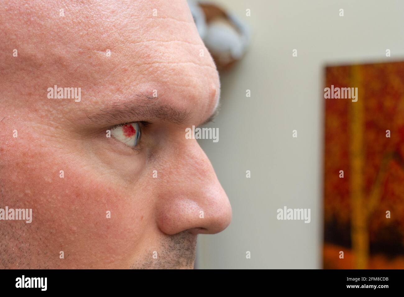 A close up side profile of a subconjunctival hemorrhage red blood spot ...