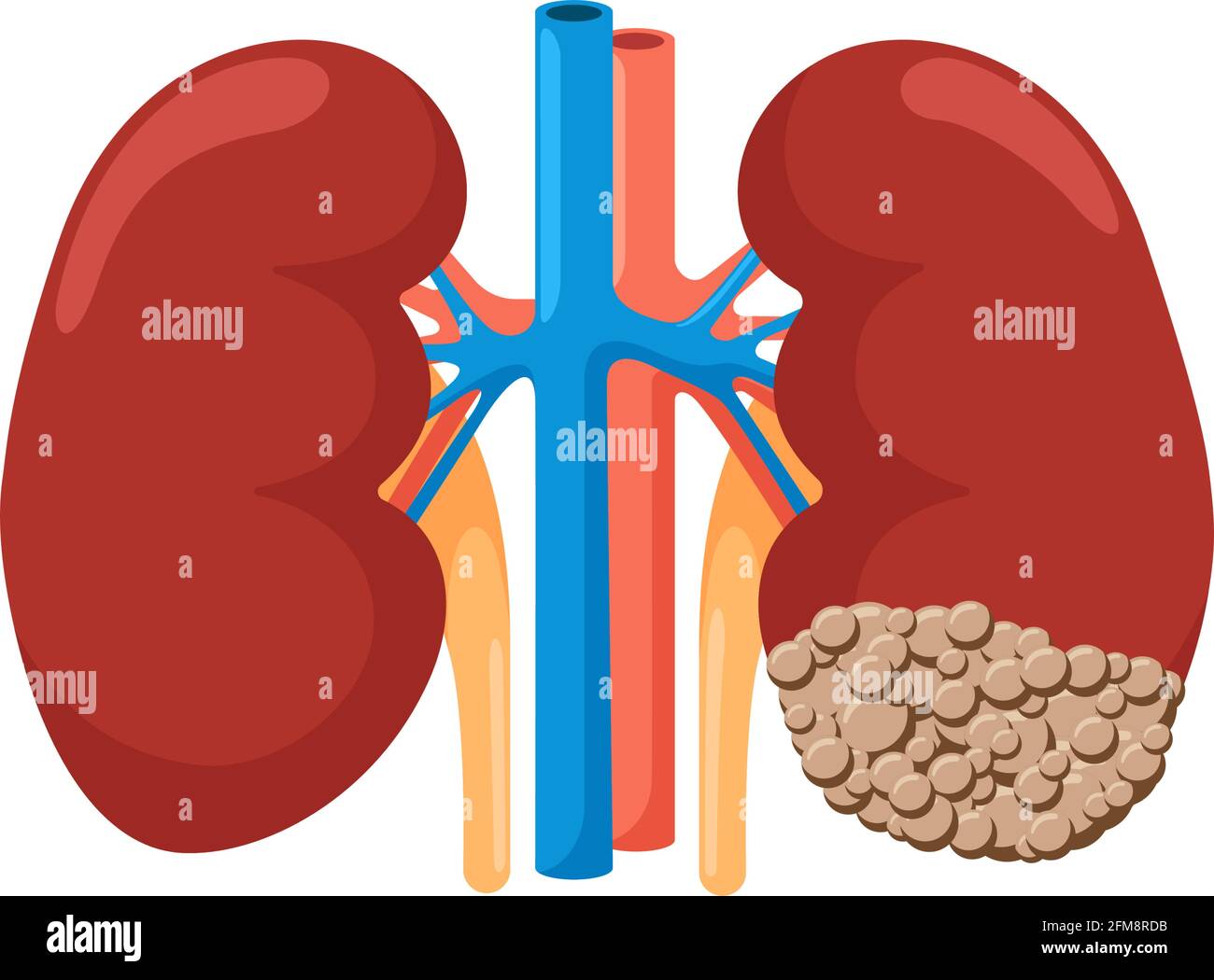 Healthy and sick kidney with cancer. Human anatomy genitourinary system ...
