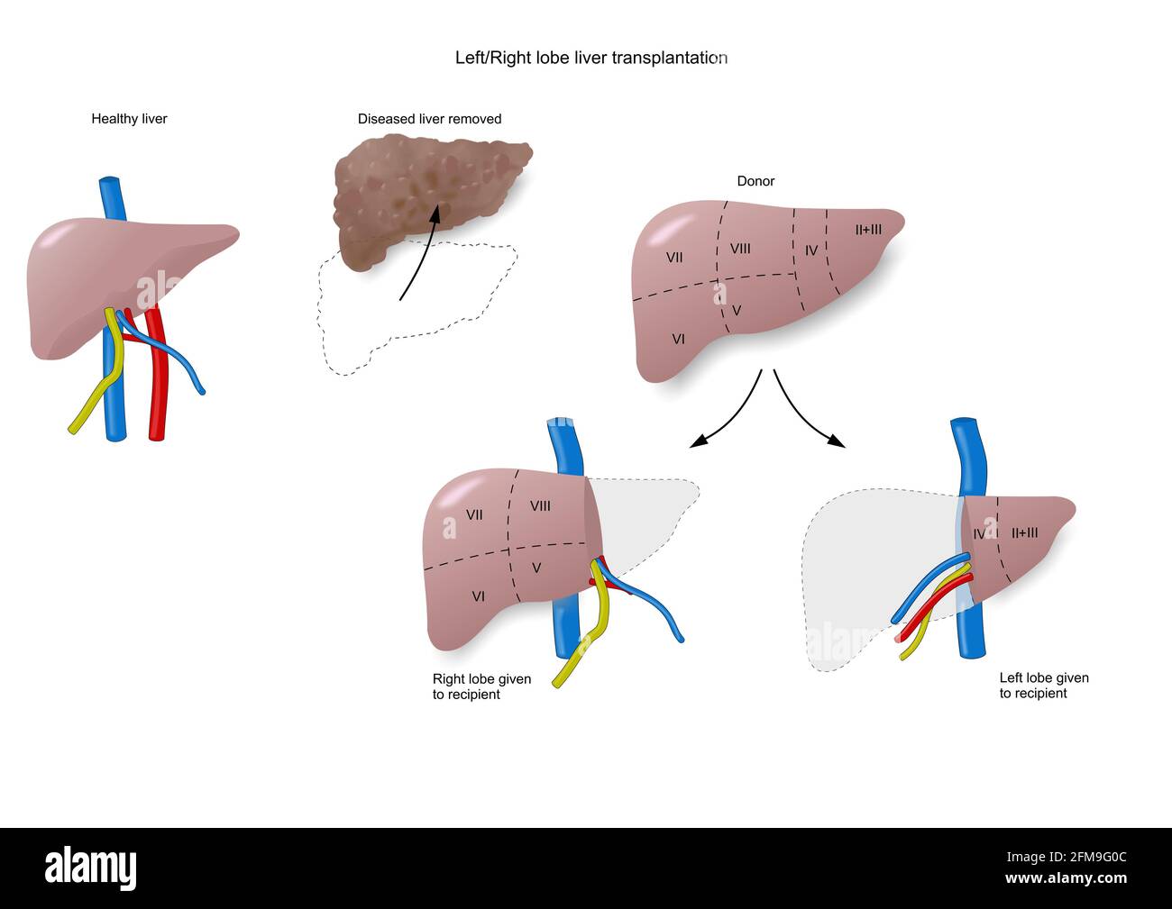 Liver pathology Cut Out Stock Images & Pictures - Alamy